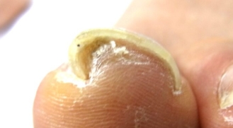 Comprendre les cors péri-unguéaux et leur traitement – AD Pédicure Médicale